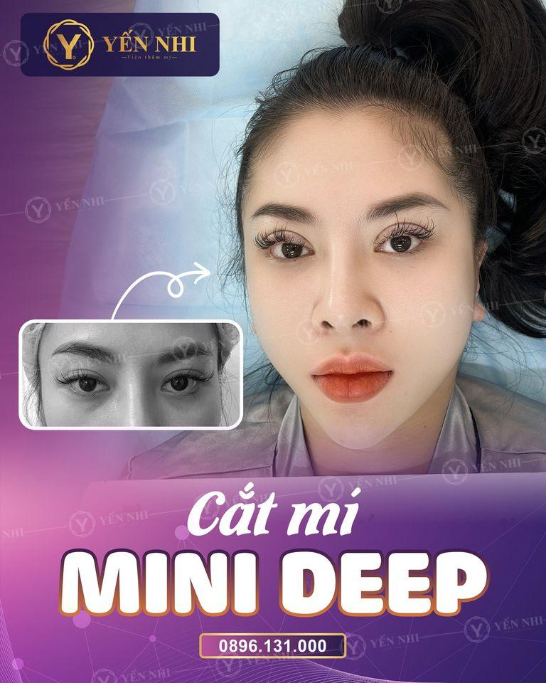 CÔNG NGHỆ CẮT MÍ MINI DEEP CÓ GÌ ĐẶC BIỆT? | Viện Thẩm Mỹ Yến Nhi